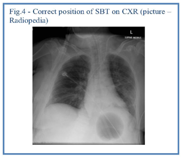 CLINY Paediatric Sengstaken-Blakemore tube (S-BT) insertion protocol ...