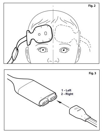 Cerebral Near Infrared Spectroscopy (NIRS): clinical guideline | Right ...
